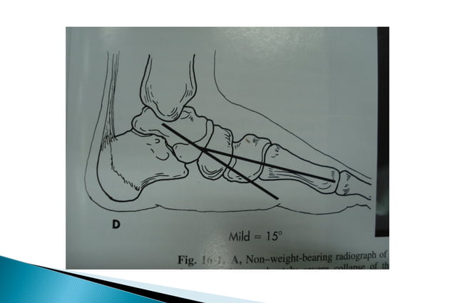 Flat foot | PPT | Death, Injury, or Military Conflict | Sensitive Topics