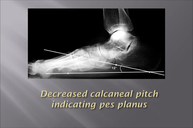 Pes Planus by Dr. Mohammad Azhar ud din Darokhan | PPT | Death, Injury ...