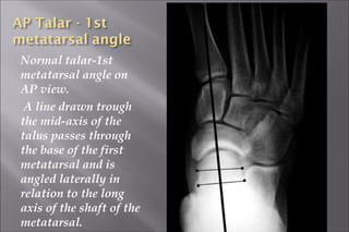 Pes Planus by Dr. Mohammad Azhar ud din Darokhan | PPT