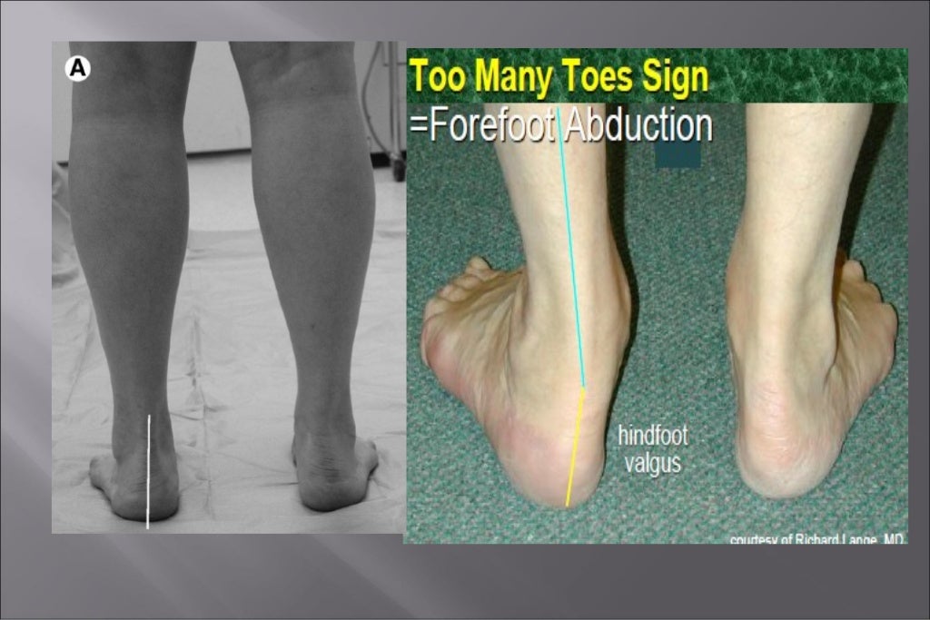 Pes Planus by Dr. Mohammad Azhar ud din Darokhan