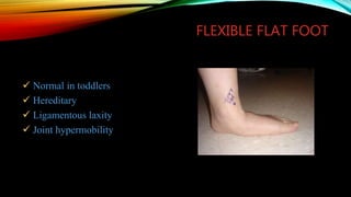 Flat foot By Dr.Mahbub | PPTX | Death, Injury, or Military Conflict ...