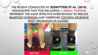 FLAT FOOT gait deviations and how to fix .pptx
