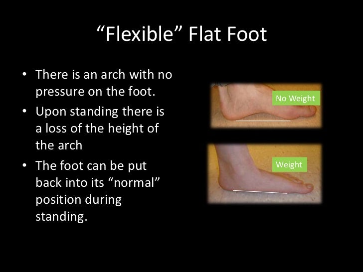 Flatfoot versus Talotarsal Displacement