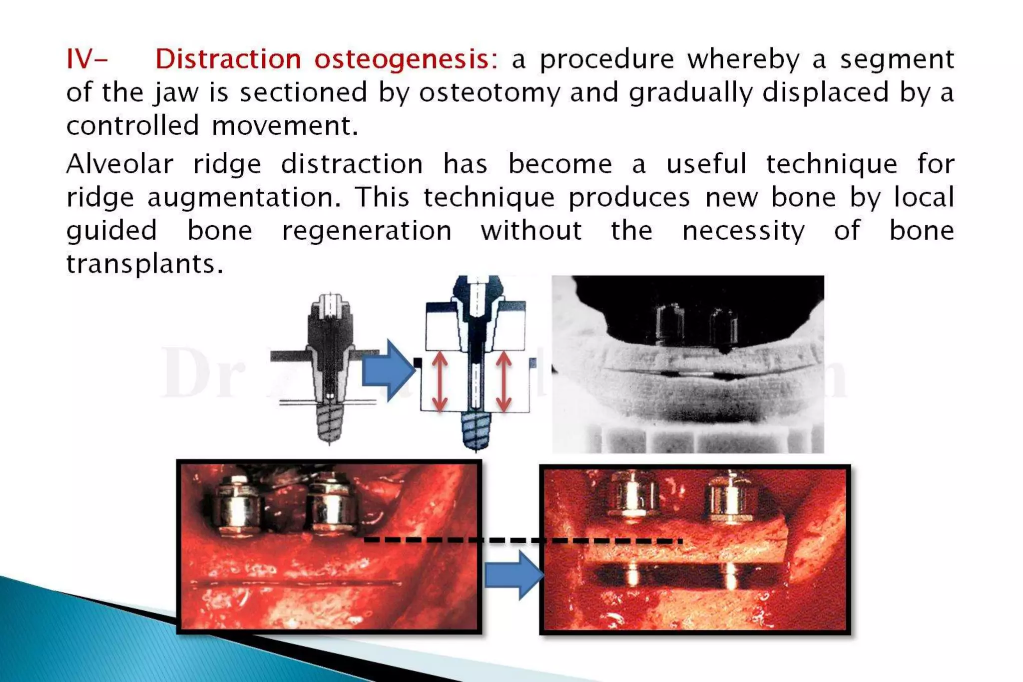 Flat ridge management | PPTX
