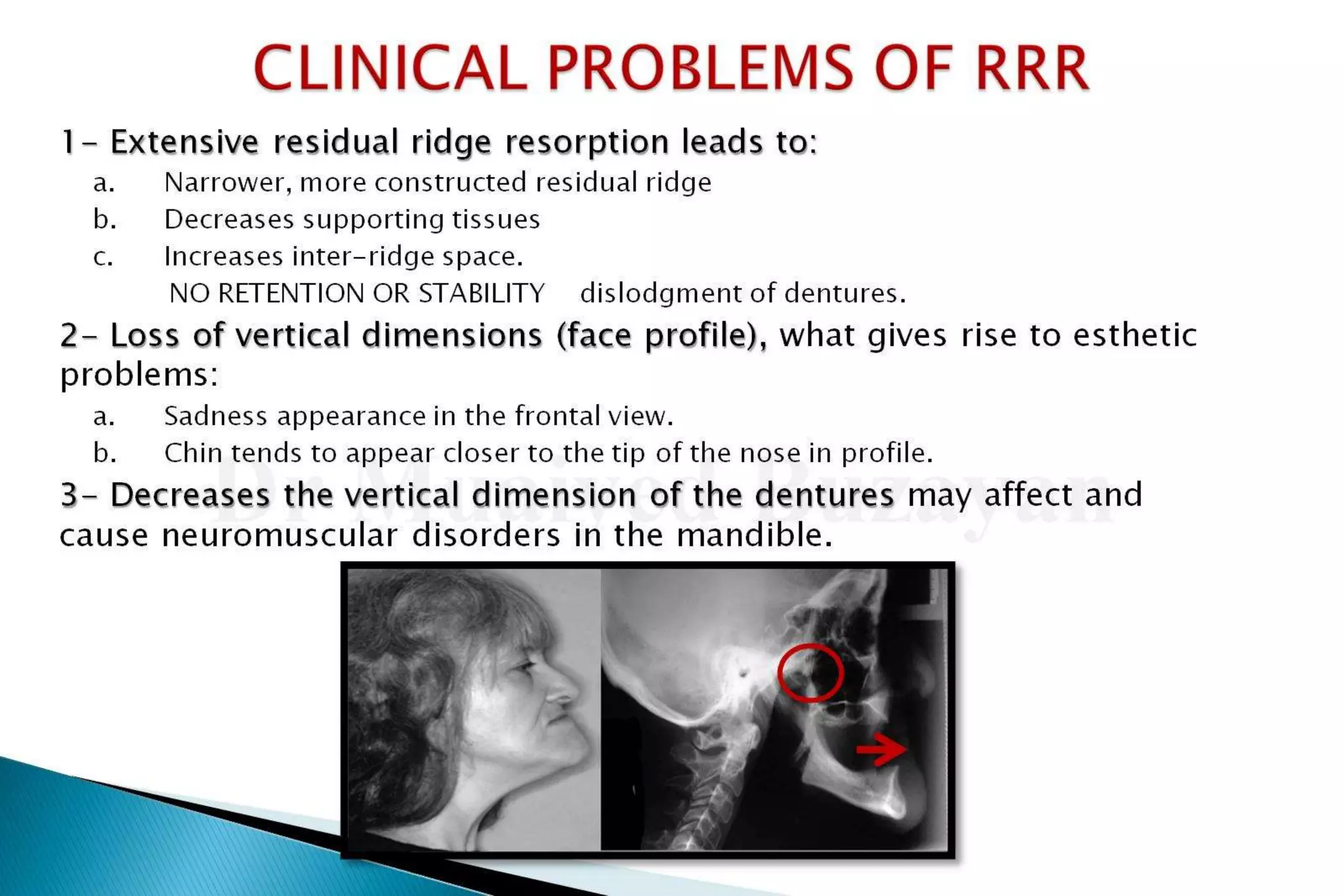 Flat ridge management | PPTX