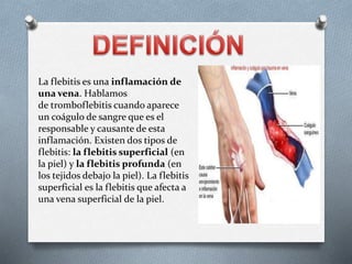 FLEBITIS | PPTX