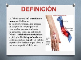 Flebitis | PPTX