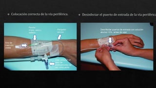 Flebitis | PPTX