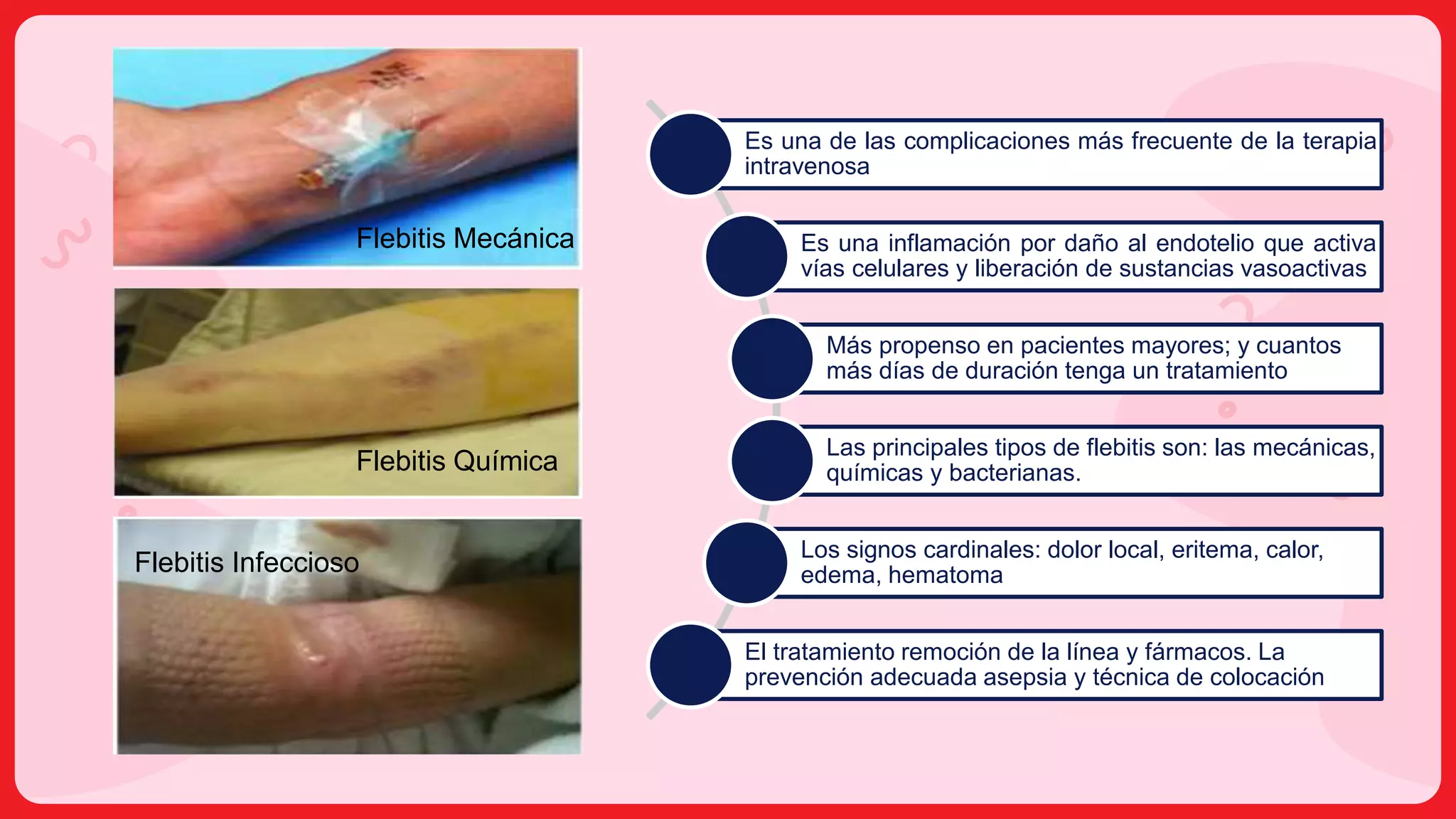 Flebitis Cx.pptx