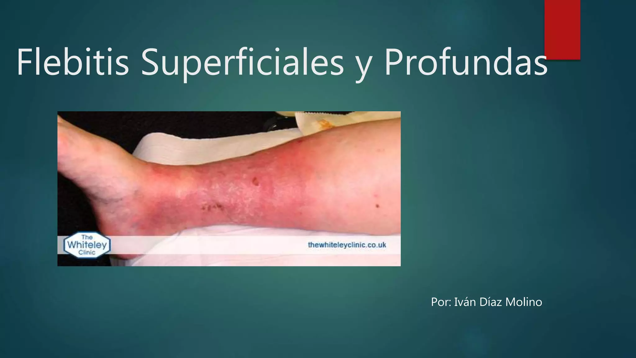 Flebitis superficiales y profundas | PPTX