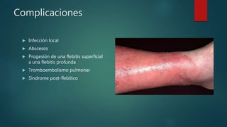 Flebitis superficiales y profundas | PPTX