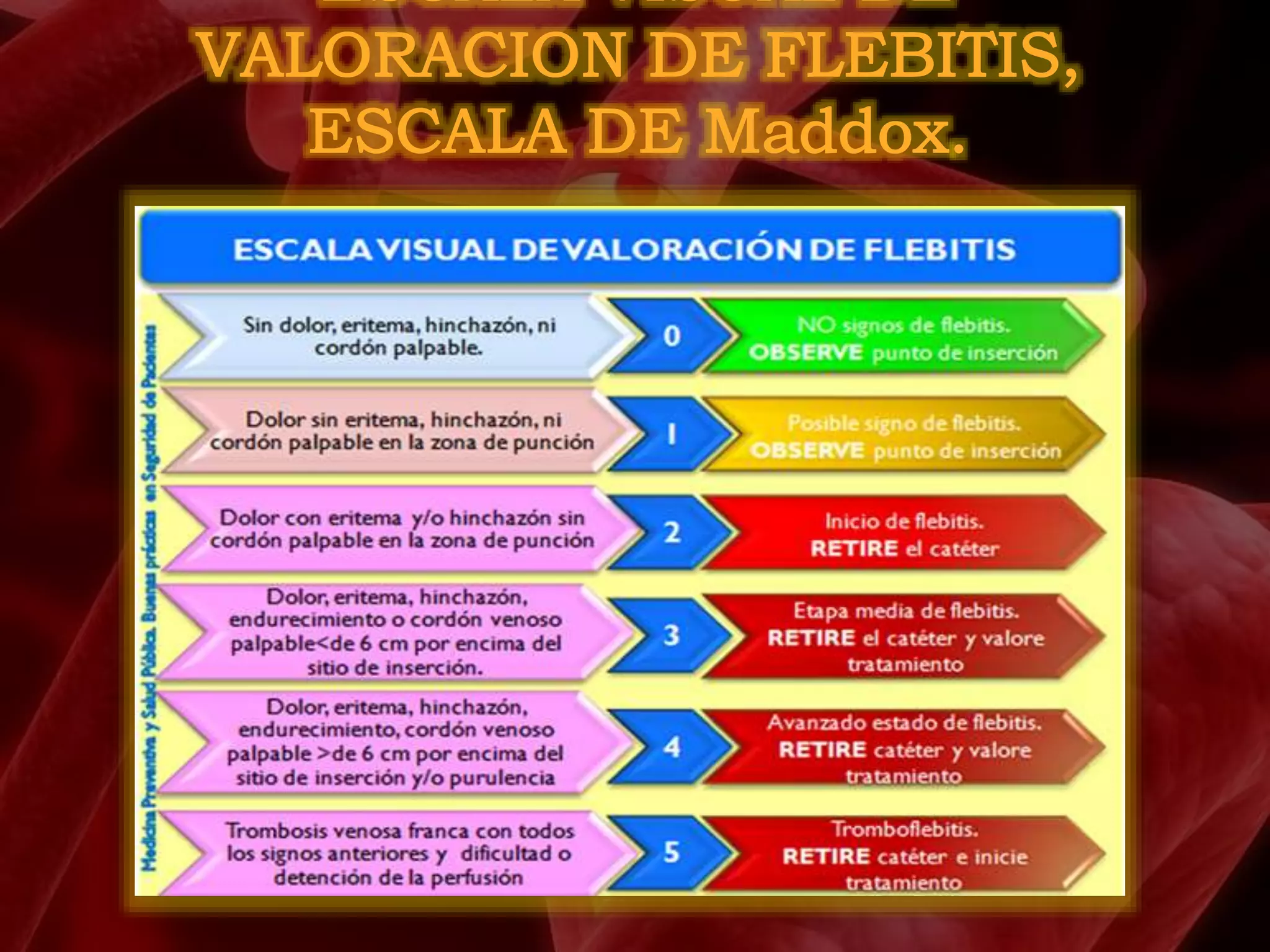Flebitis | PPTX