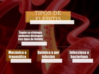 Flebitis | PPTX