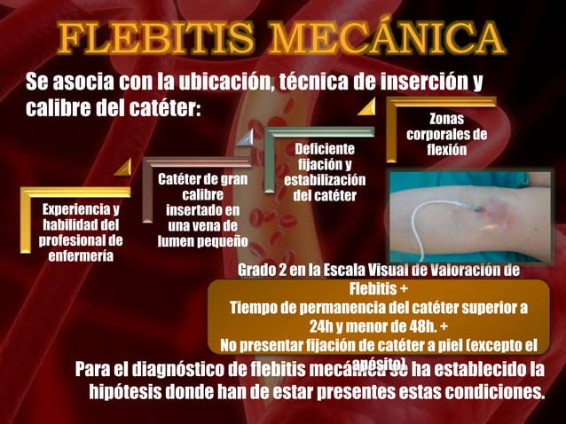 Flebitis | PPTX