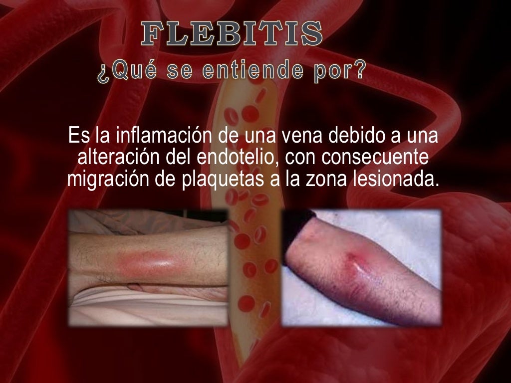 Flebitis