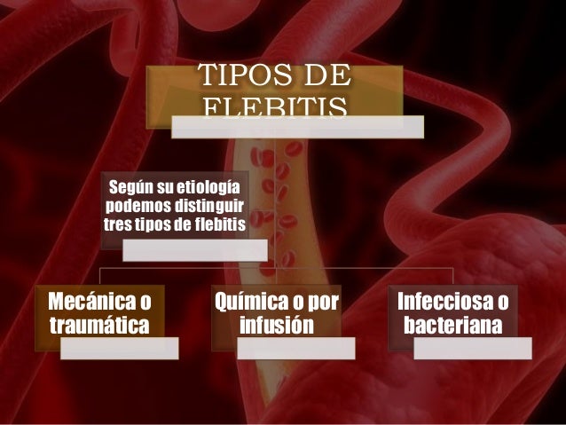 Flebitis