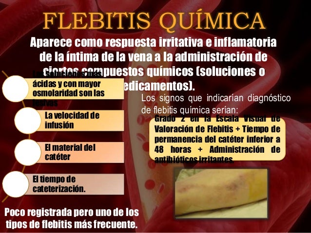 Flebitis