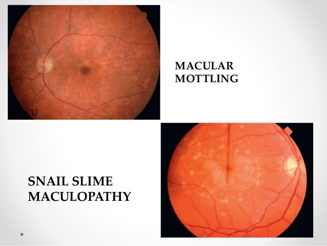 Fleck retina dr zeeshan