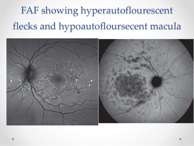 Fleck retina dr zeeshan
