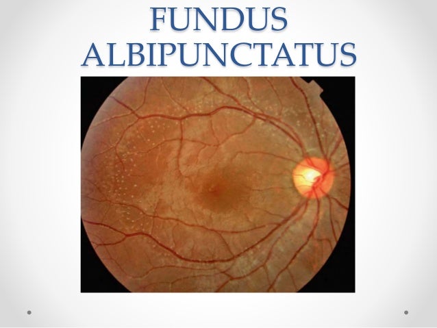 Fleck retina dr zeeshan