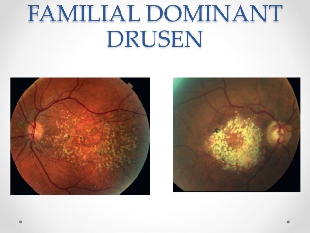 Fleck retina dr zeeshan