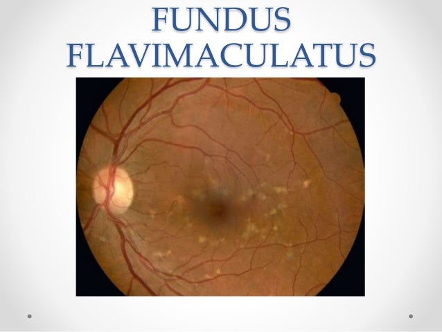 Fleck retina dr zeeshan