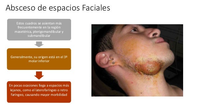 Flegmones oro faringeos