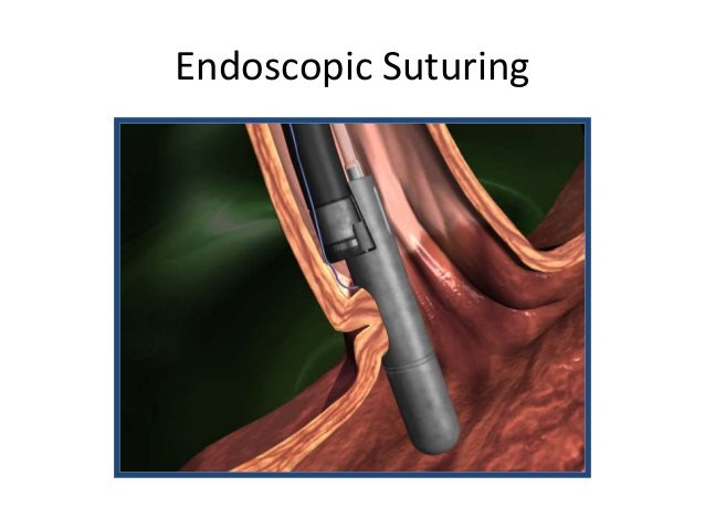 Flexible endoscopy a surgeon's perspective