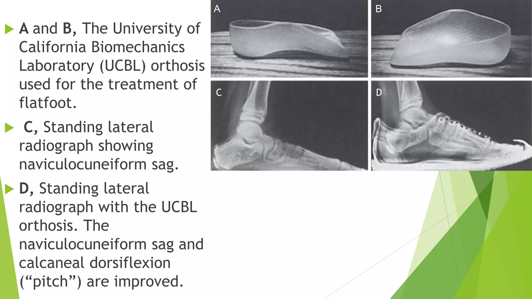 Flexible flatfoot (pes planovalgus) | PPTX