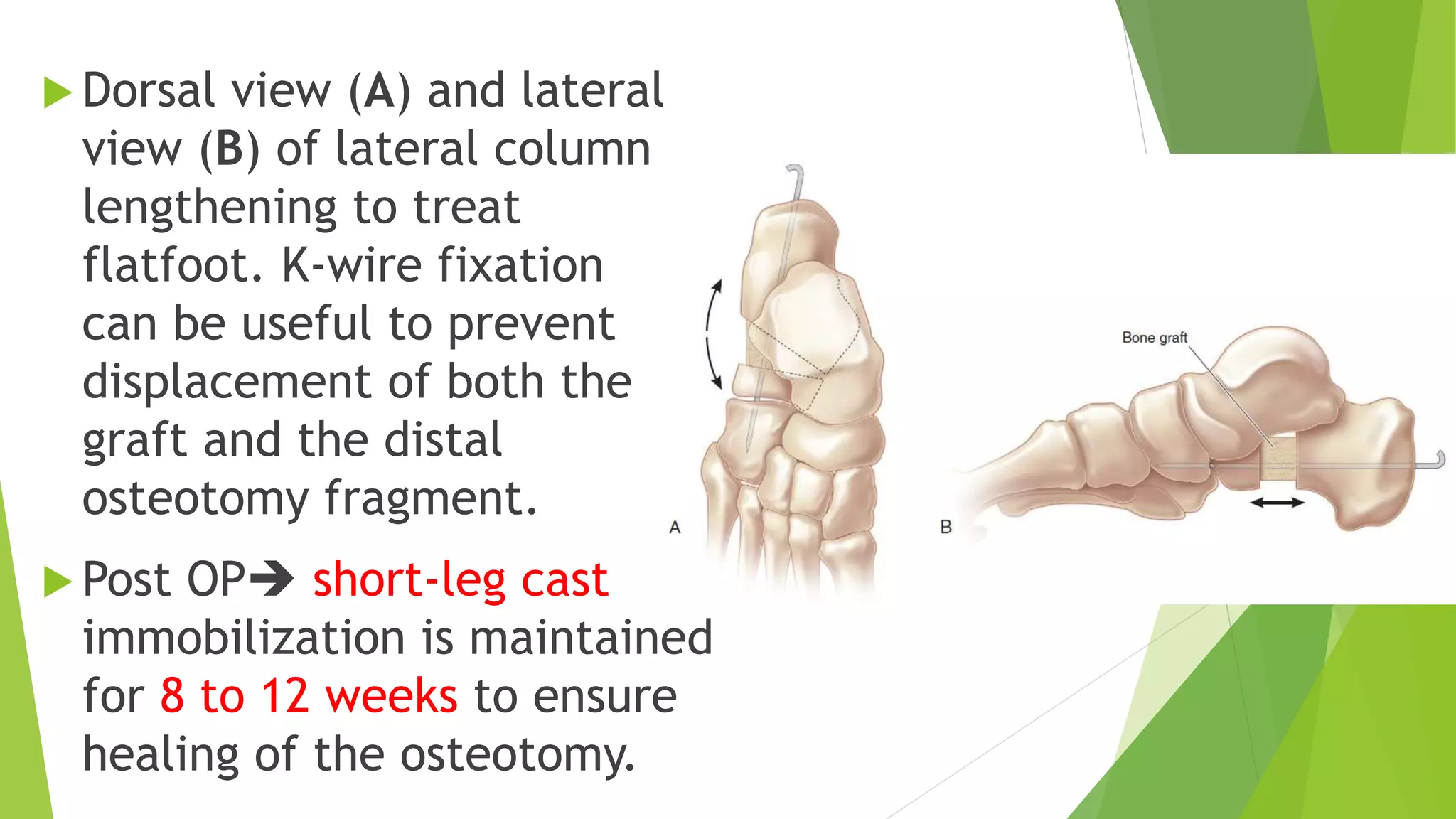 Flexible flatfoot (pes planovalgus) | PPTX