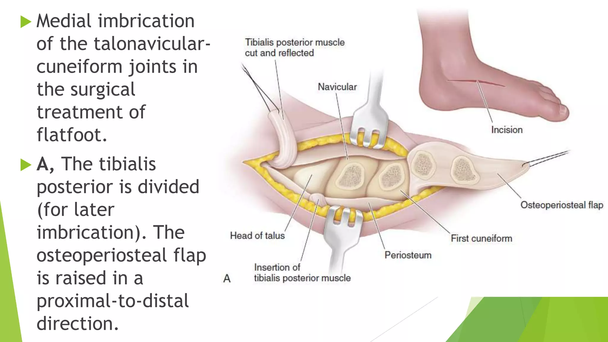 Flexible flatfoot (pes planovalgus) | PPTX