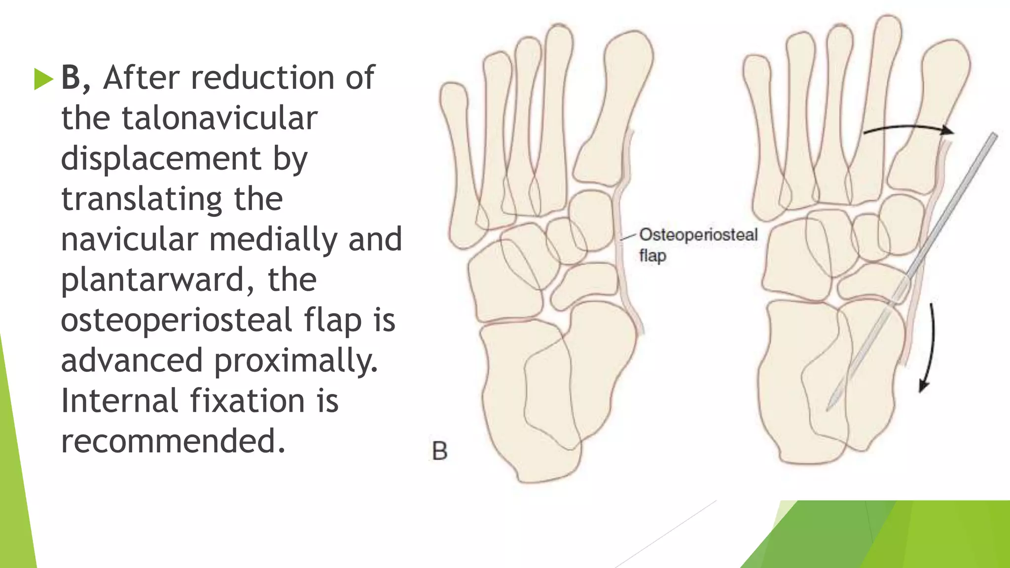 Flexible flatfoot (pes planovalgus) | PPTX