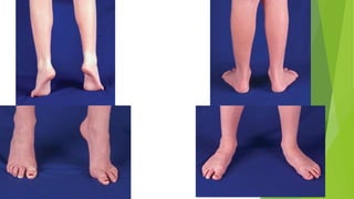 Flexible flatfoot (pes planovalgus) | PPTX