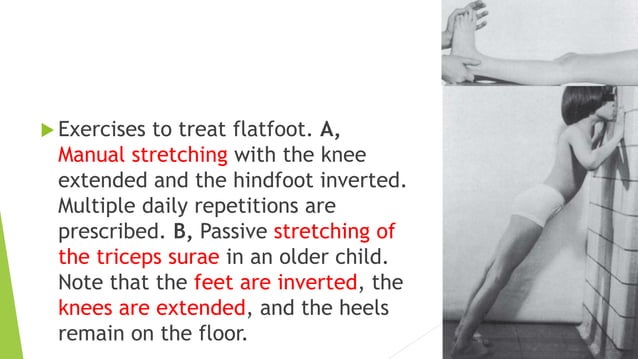 Flexible flatfoot (pes planovalgus) | PPTX | Death, Injury, or Military ...