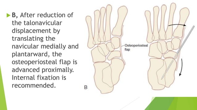 Flexible flatfoot (pes planovalgus) | PPTX | Death, Injury, or Military ...