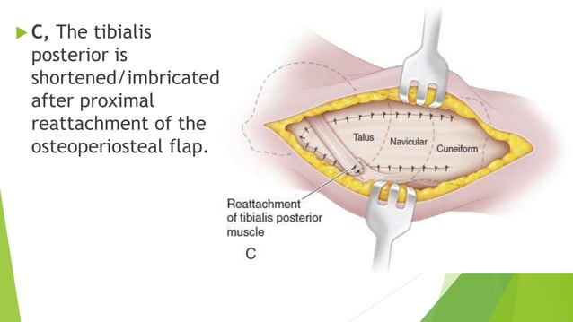 Flexible flatfoot (pes planovalgus) | PPTX | Death, Injury, or Military ...
