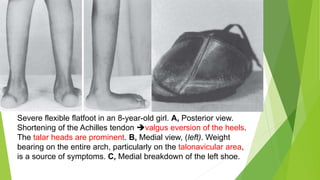Flexible flatfoot (pes planovalgus) | PPTX