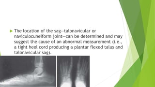 Flexible flatfoot (pes planovalgus) | PPTX