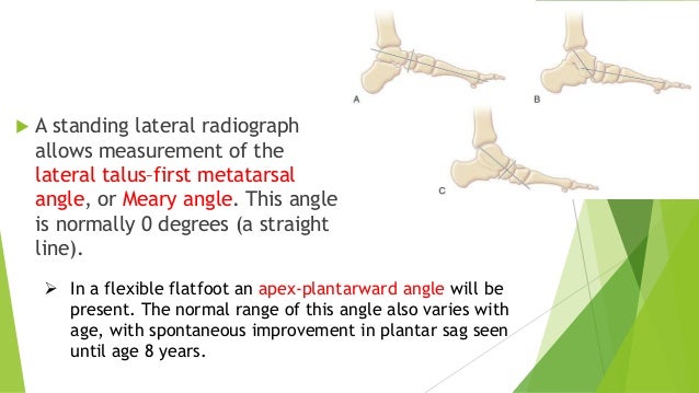 Flexible flatfoot (pes planovalgus)