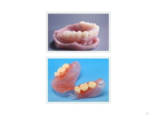 Claspless Partial Dentures