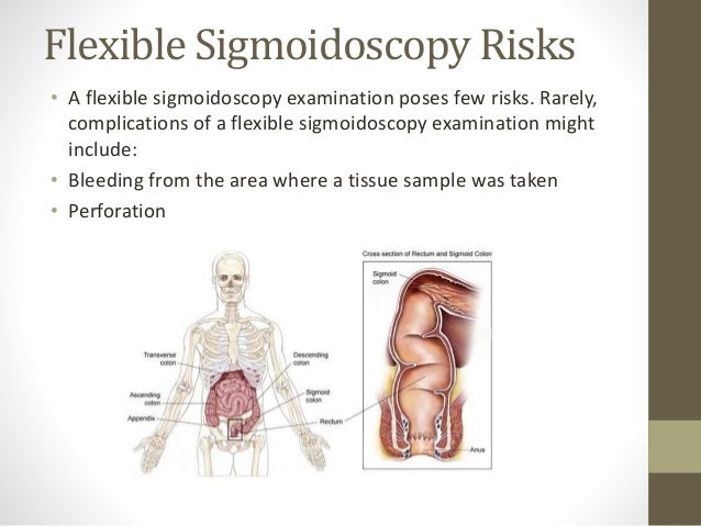 Flexible sigmoidoscopy procedure