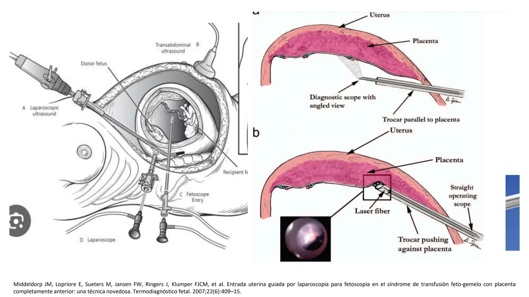 Flexible Video Fetoscopy.pptx
