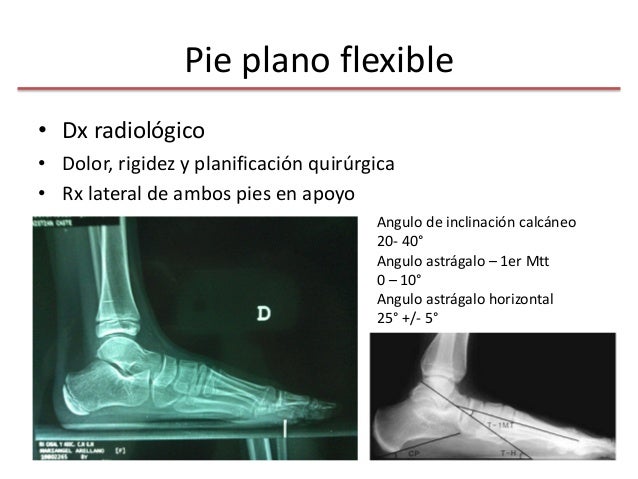 Pie plano flexible vs pie plano rigido