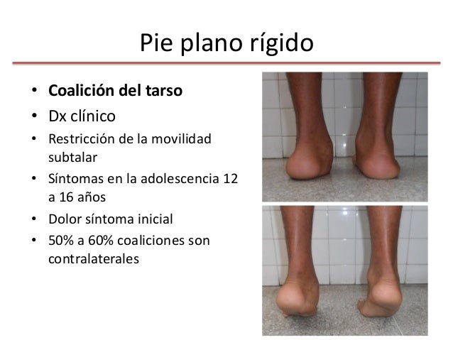 Pie plano flexible vs pie plano rigido