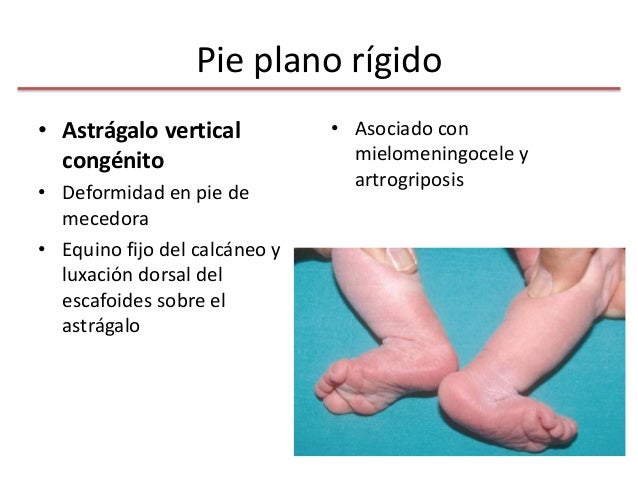 Pie plano flexible vs pie plano rigido