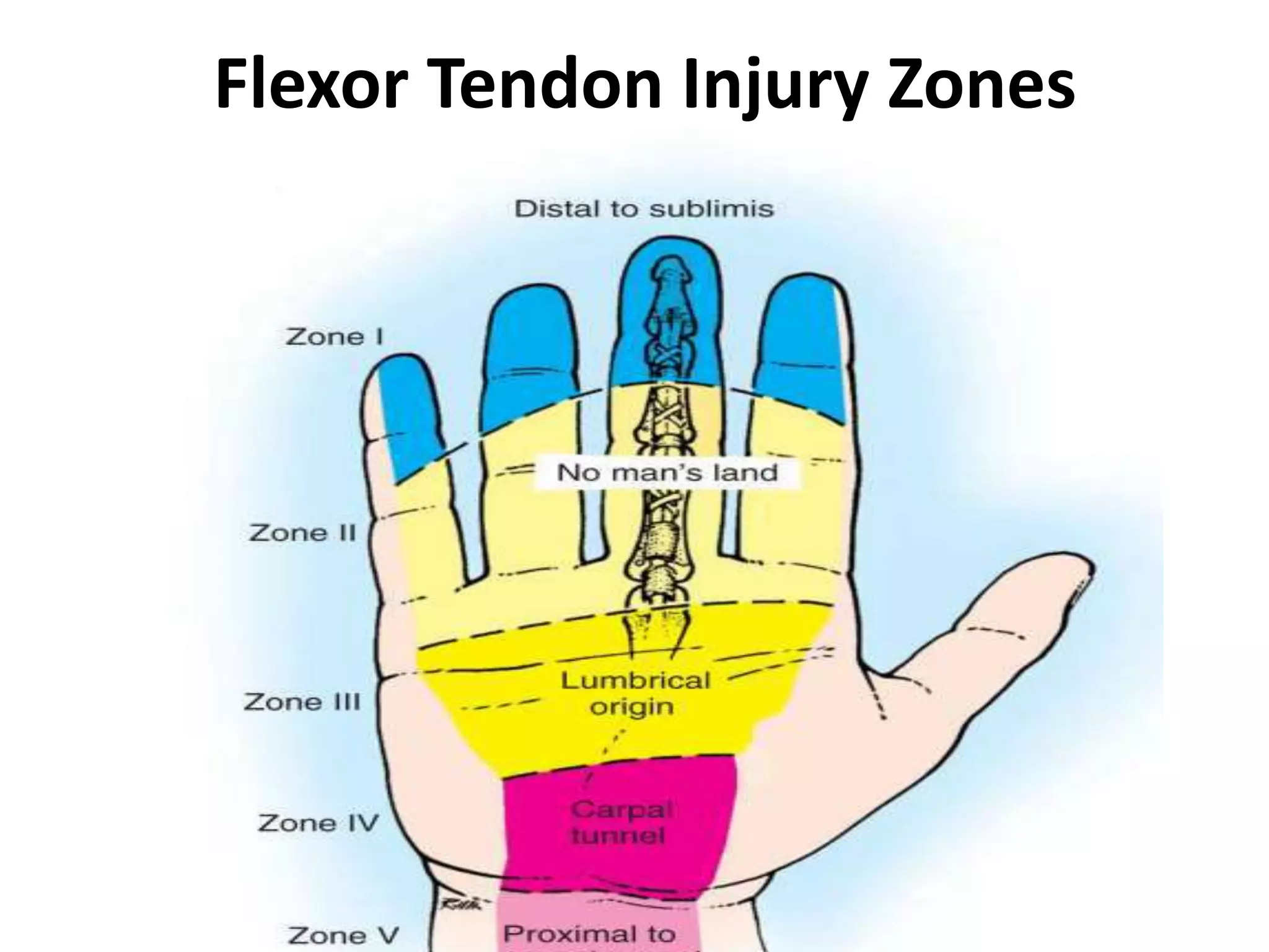 Flexion Tendon Injuries Of Hand Pptx
