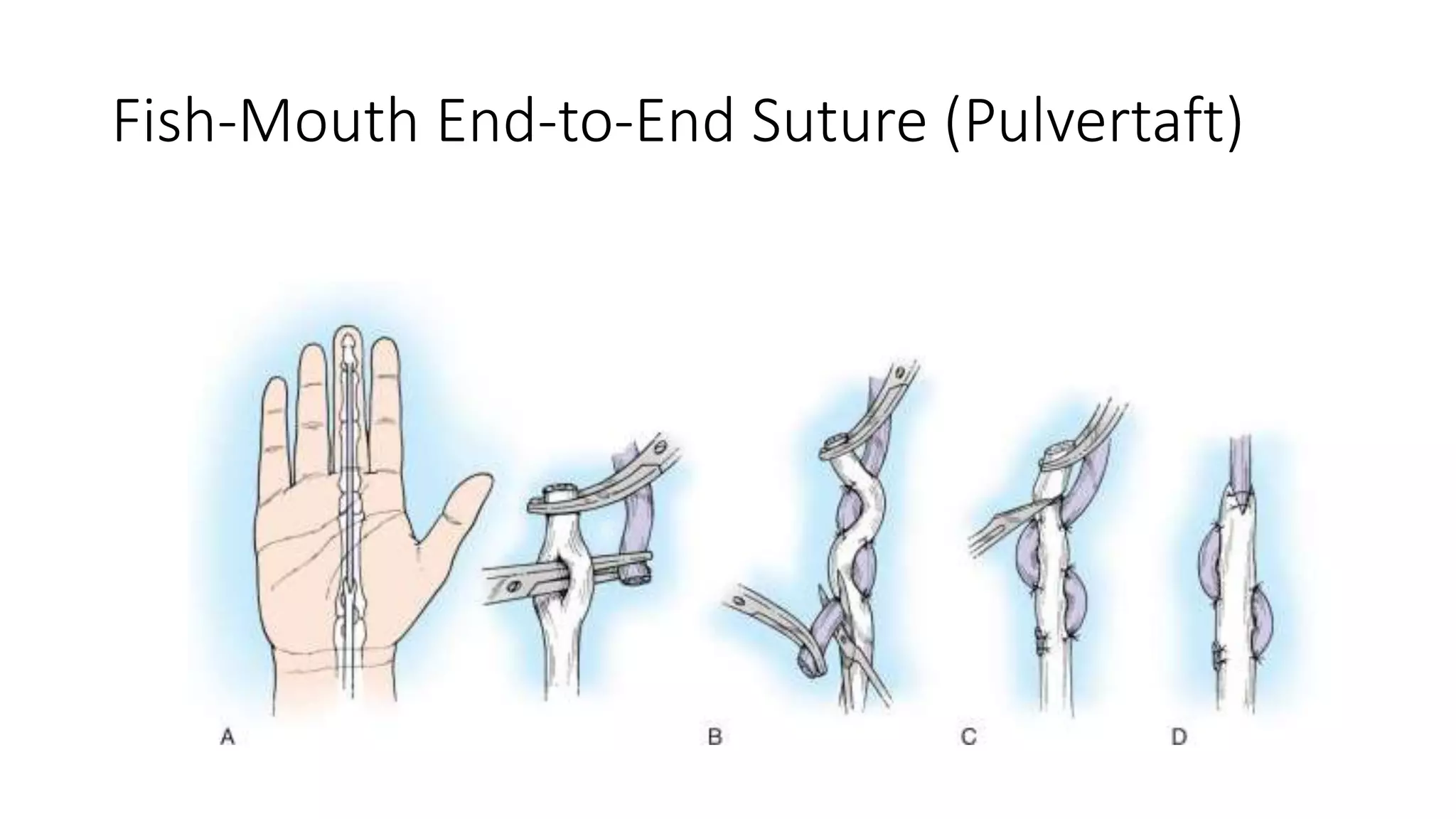 Flexor and extensor tendon injury | PPTX
