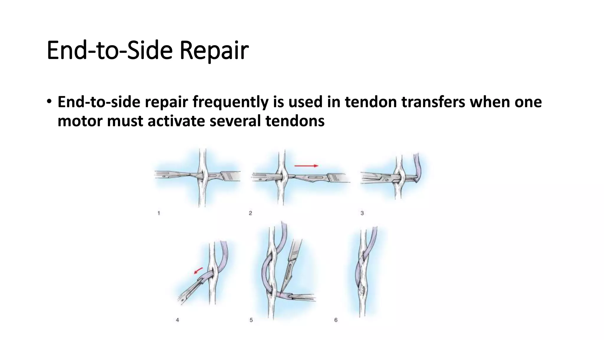 Flexor and extensor tendon injury | PPTX