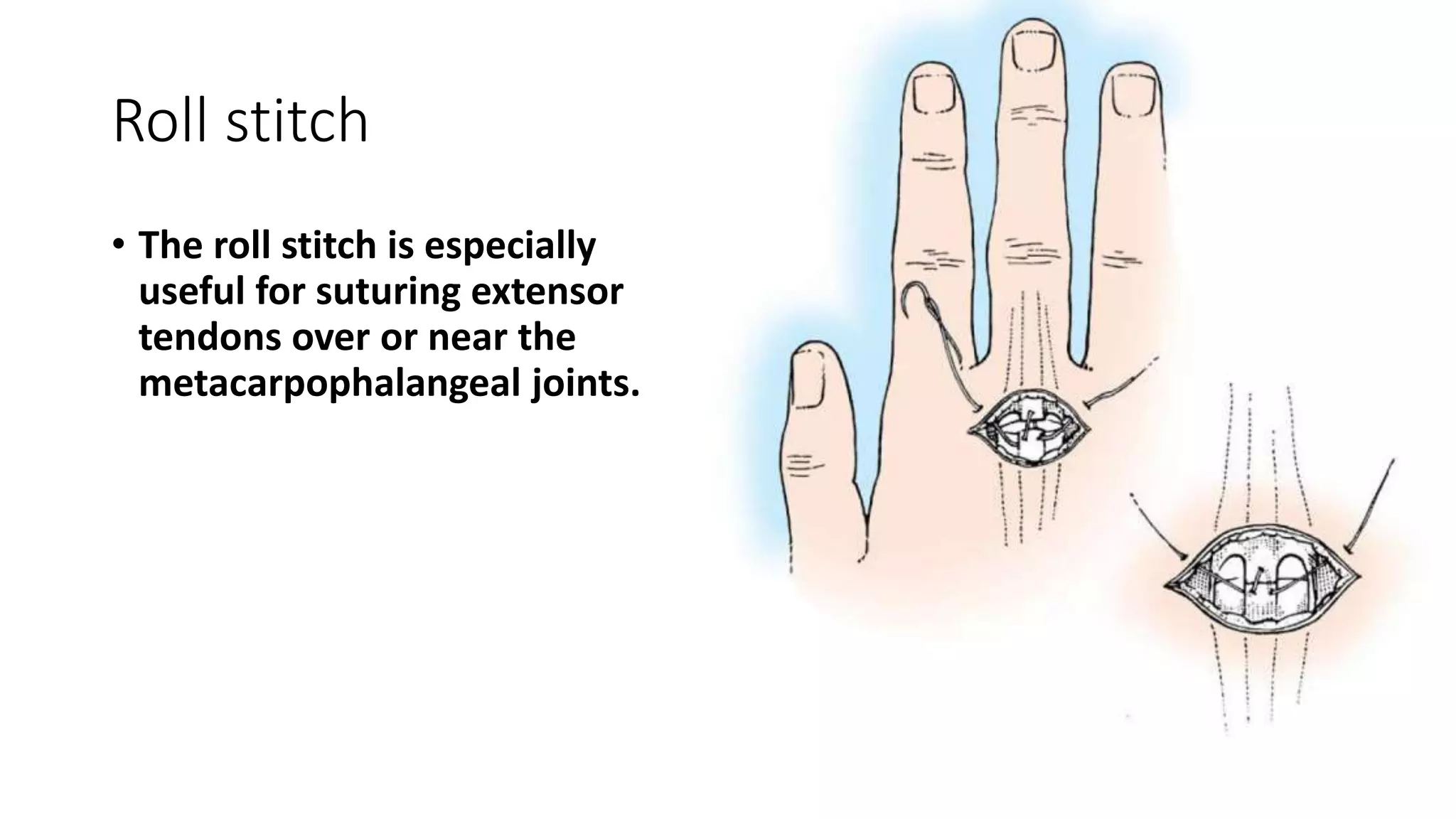 Flexor and extensor tendon injury | PPTX