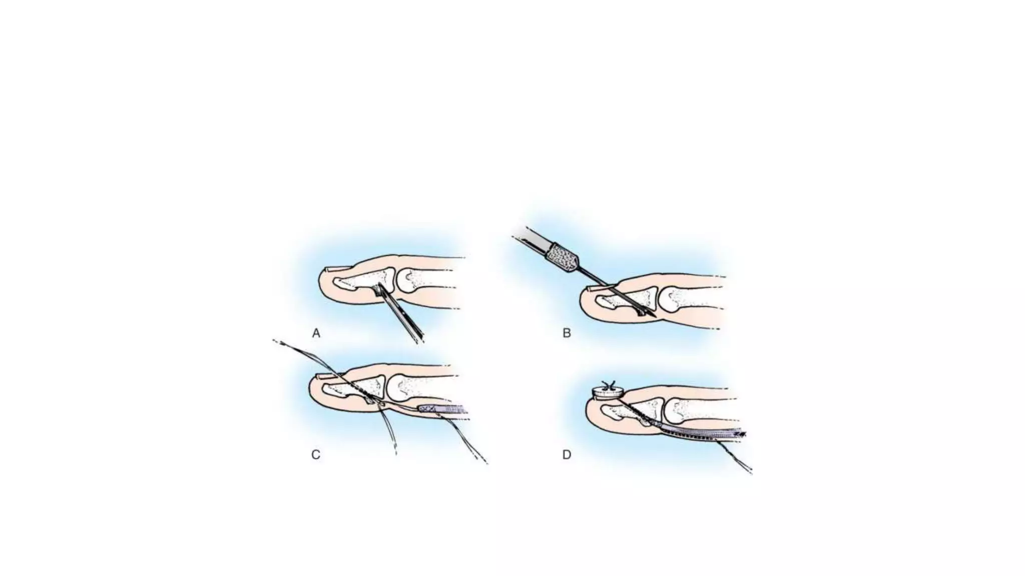Flexor and extensor tendon injury | PPTX